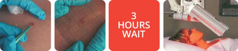 Toowong | Photodynamic Therapy (PDT)